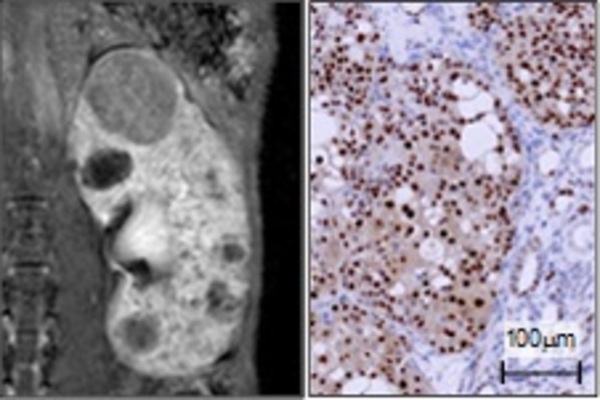 【Publications】TFE3 Xp11.2 translocation renal cell carcinoma mouse ...